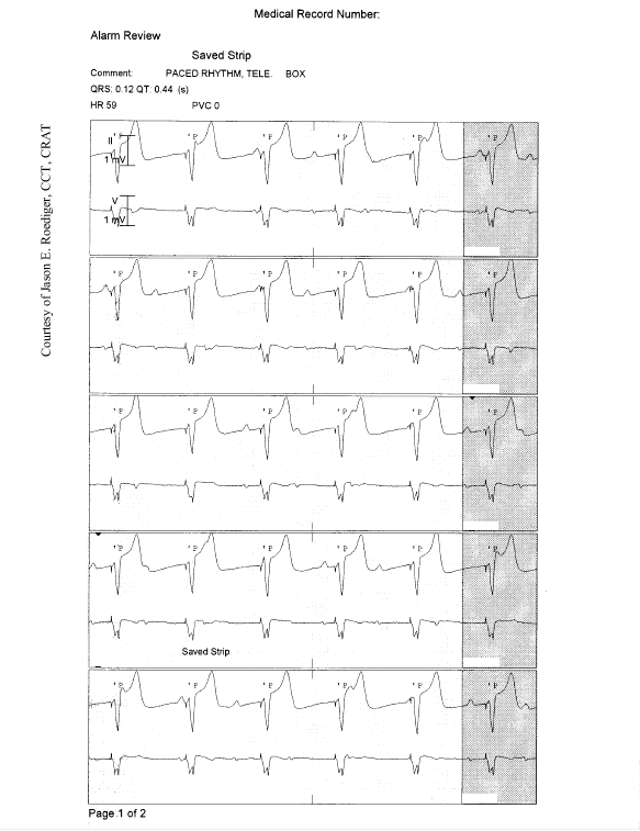 Ventriculophasic sinus arrhythmia | ECG Guru - Instructor Resources
